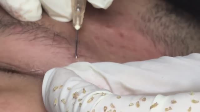 Устранение подкожных прыщей, черных точек и воспаленных угрей