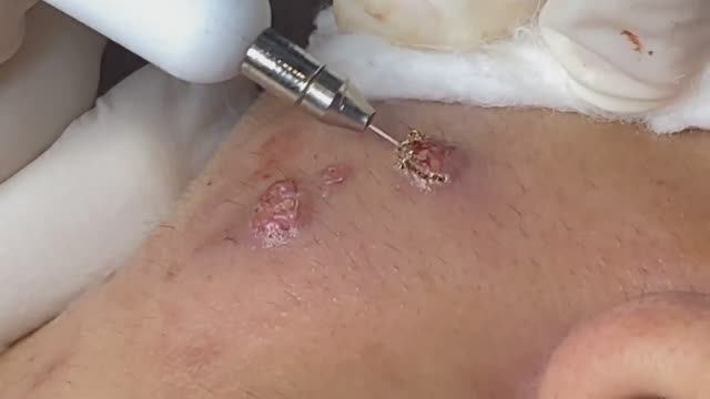 Огромные бородавки на щеке. Удаление.