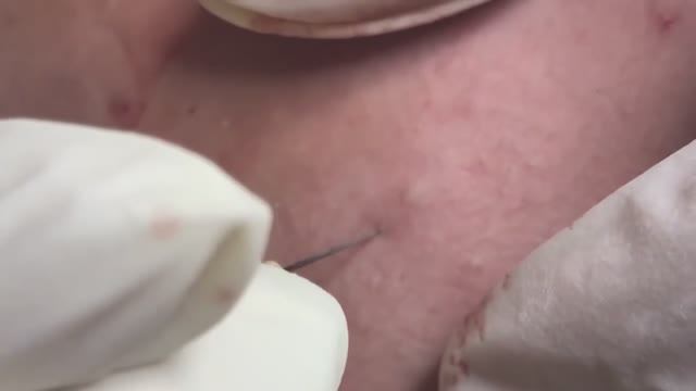 Лечение подкожных, воспалительных и кистозных прыщей