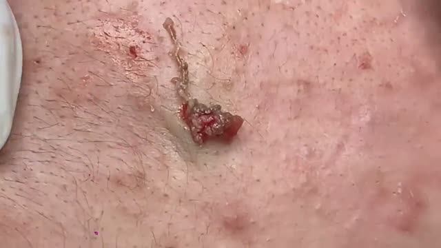 Прыщи, которые появляются из ниоткуда #прыщи #угри