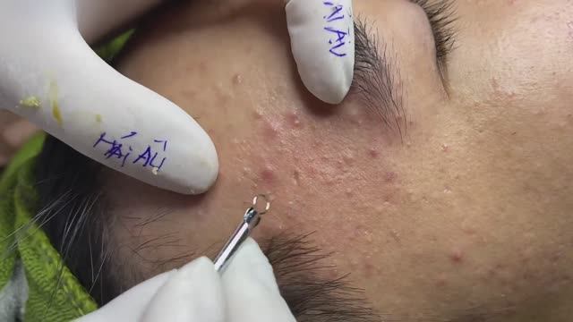 Прыщи / Акне в переходном возрасте. #акне #механическаячистка