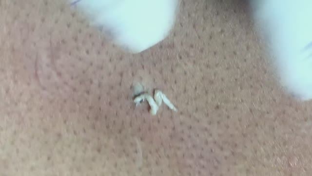 Профессиональное удаление акне #акне #постакне #механическаячистка