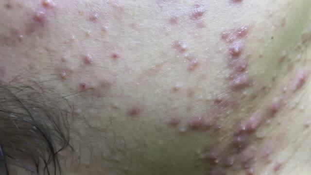 Asmr. Профессиональное избавление от черных точек.