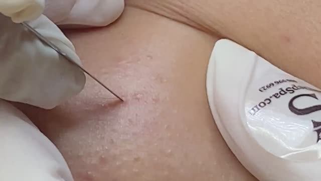Глубокие подкожные прыщи. Механическое удаление