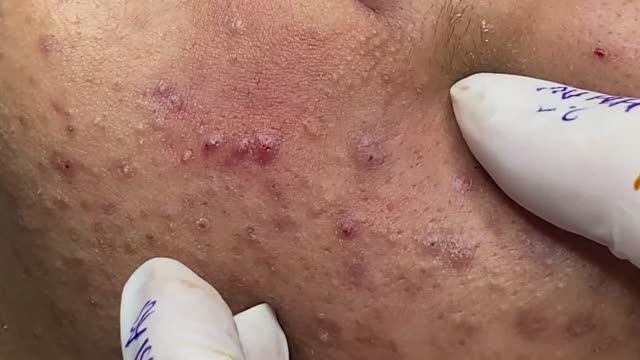 Лечение прыщей в 14 лет. Часть 4: невероятный результат