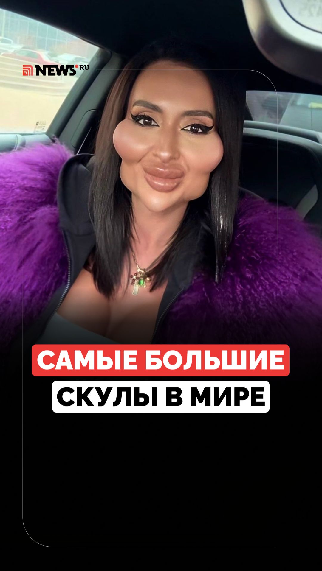 Скулы, губы и ягодицы. На что идёт девушка ради красоты?