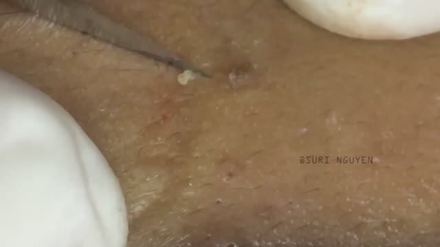 Удаление акне: эффективное лечение, которое работает. Suri Job 12