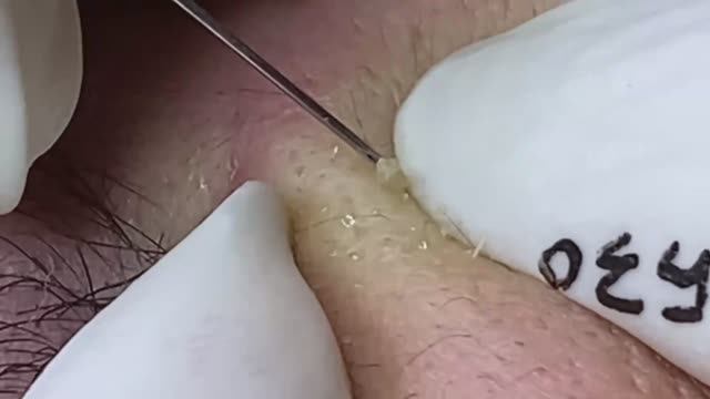 Relax Acne 016 • АСМР • Loan Nguyen collection