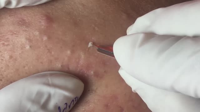 Удаление воспалённых прыщей на лице #воспаленныепрыщи #удалениепрыщей