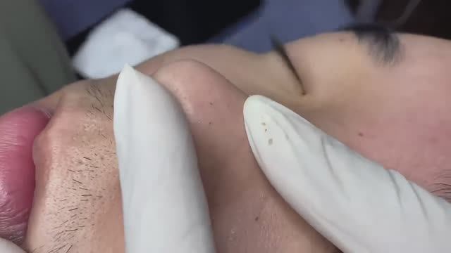 Relax Acne 017 • АСМР • Loan Nguyen collection