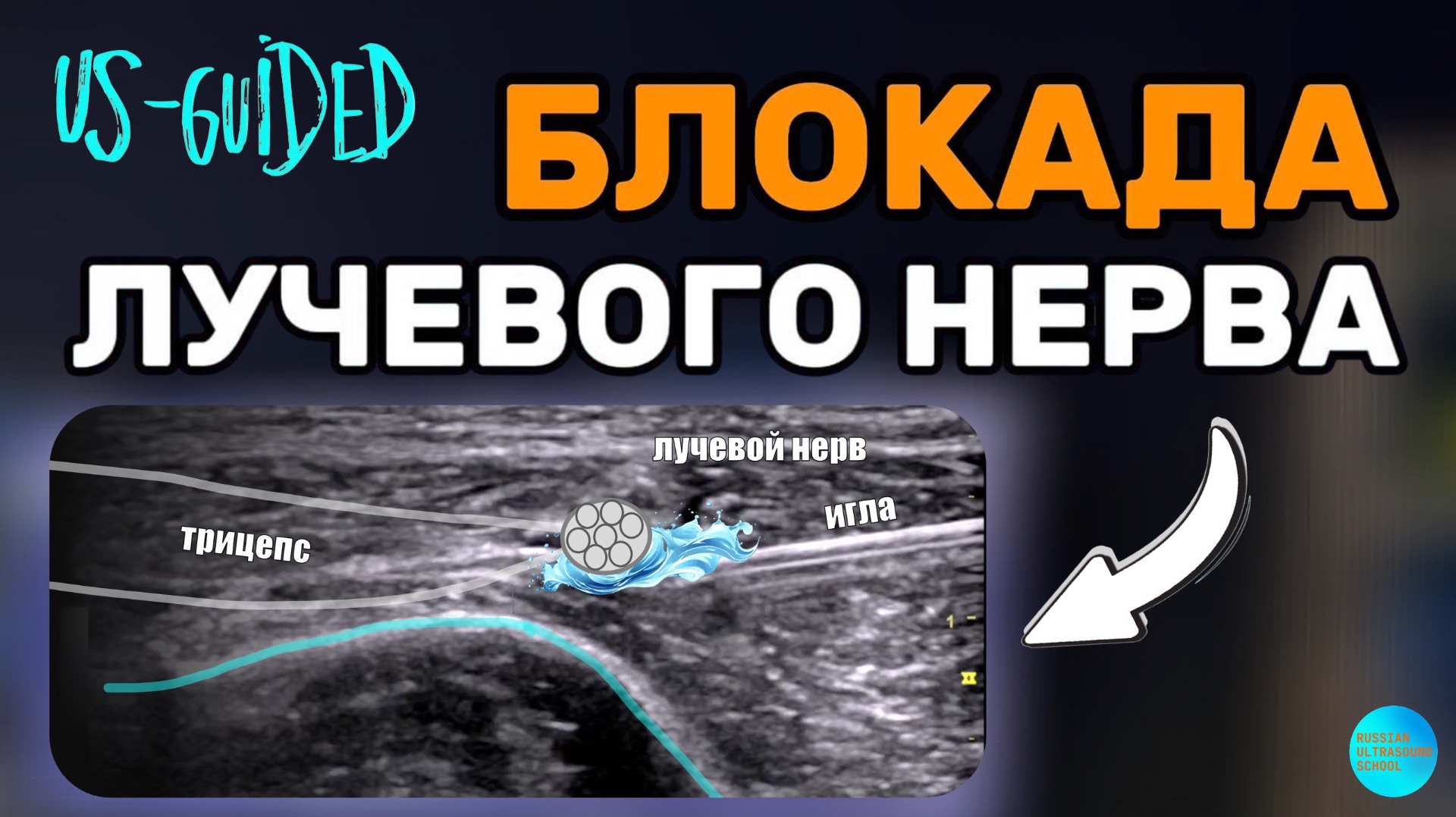 БЛОКАДА ЛУЧЕВОГО НЕРВА в нижней трети плеча. Медиальный доступ
#painmanagment #узинавигация