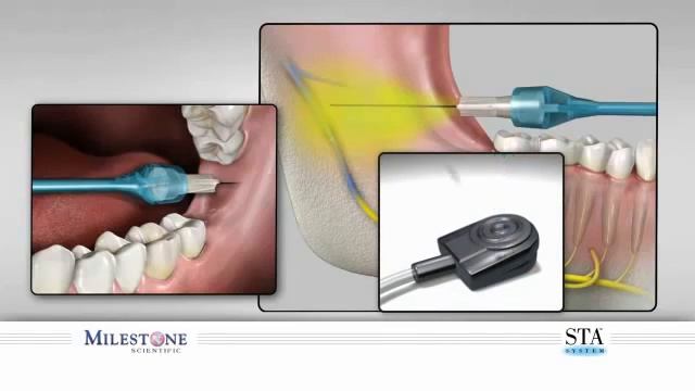 Мандибулярная анестезия CompuDent STA