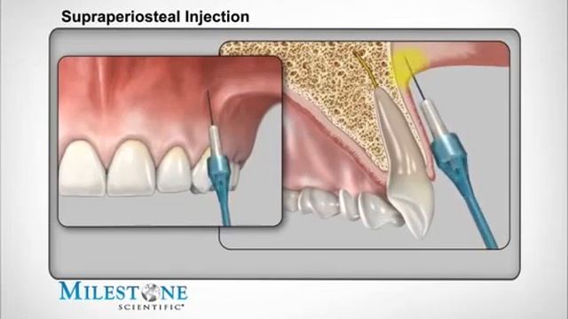 Надкостничная инфильтрационная анестезия с вестибулярной стороны альвеолярного отростка с CompuDent