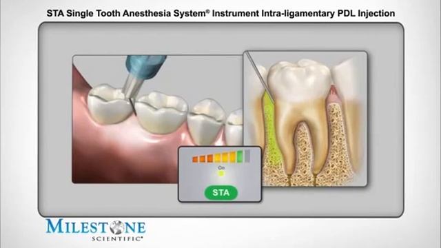 STA модифицированная интралигаментарная анестезия