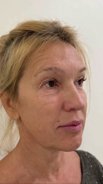 Deep Plane Facelifting: до/после 🔥