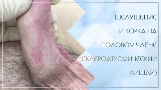 🙁 Шелушение и корка на половом члене (склероатрофический лишай).  Клинический случай №67