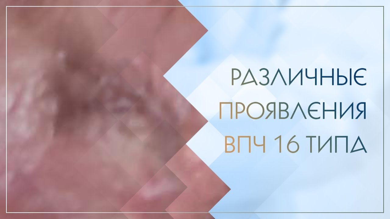 ↪ Различные проявления ВПЧ 16 типа. Клинический случай №71