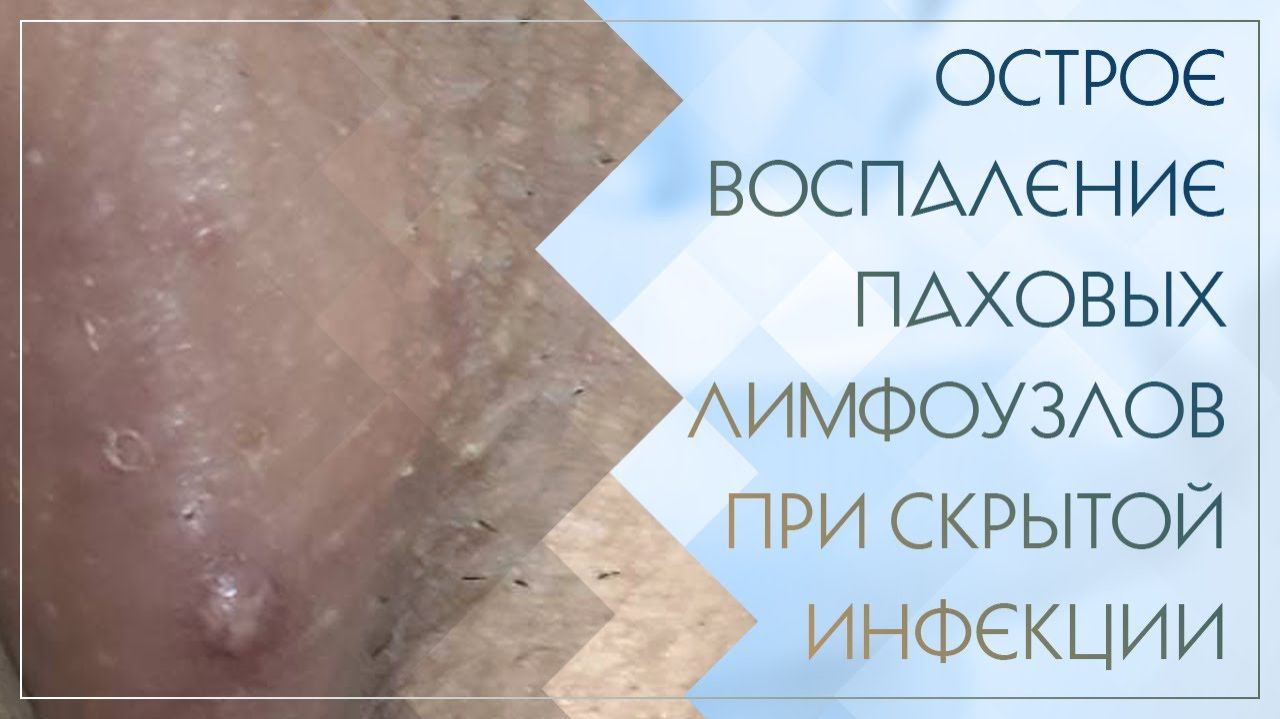 😟 Острое воспаление паховых лимфоузлов при скрытой инфекции.  Клинический случай №70