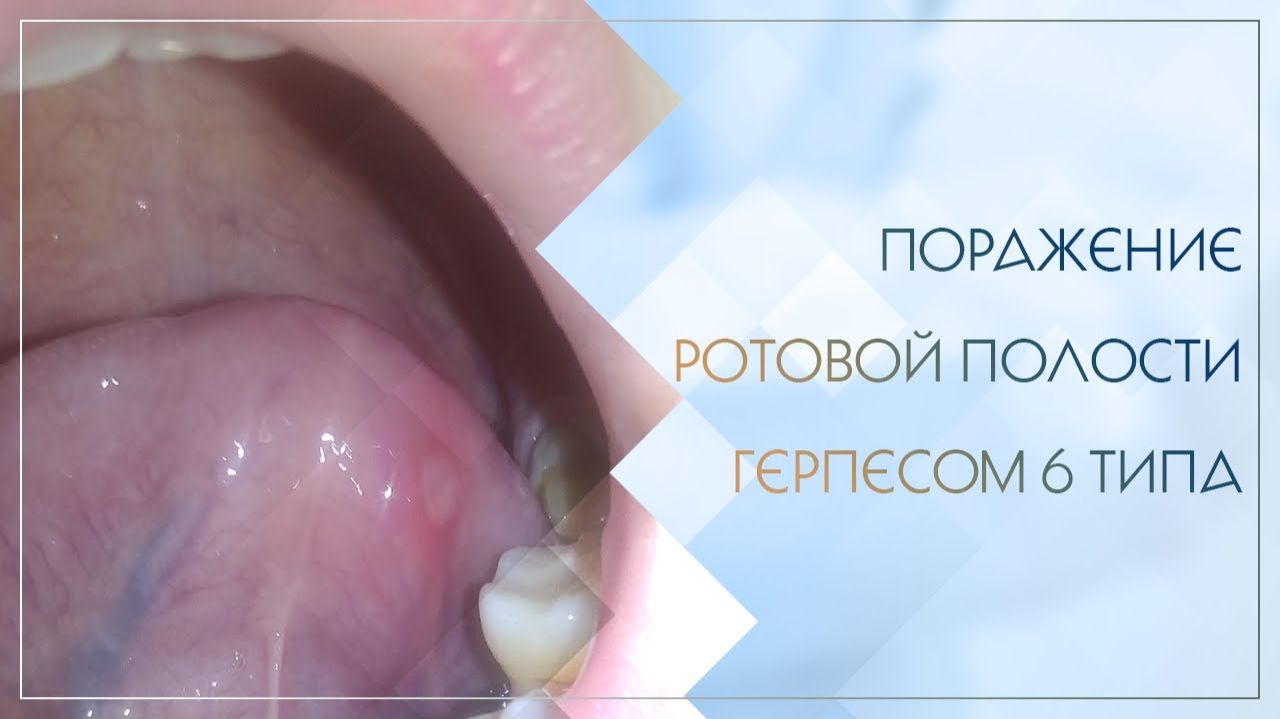 👄 Поражение ротовой полости герпесом 6 типа. Клинический случай №50