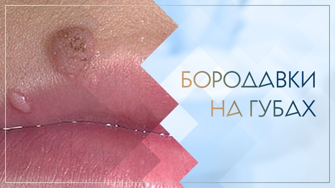 😟 Бородавки на губах. Клинический случай №52