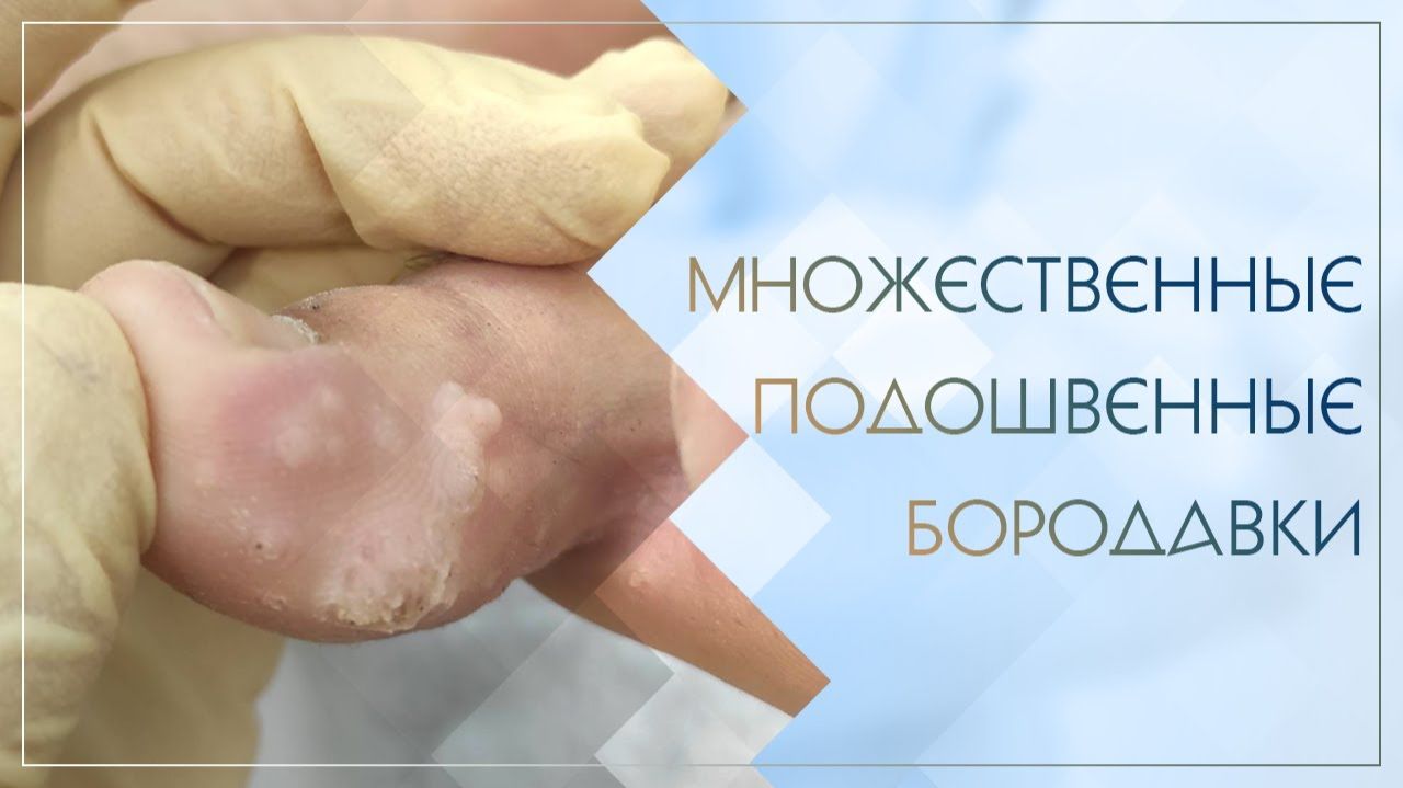 👉 Множественные подошвенные бородавки. Клинический случай №66