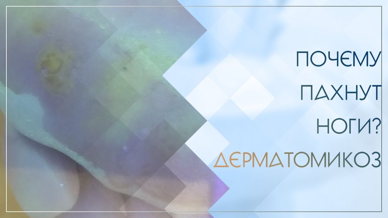 🦶 Почему пахнут ноги. Дерматомикоз. Клинический случай №44