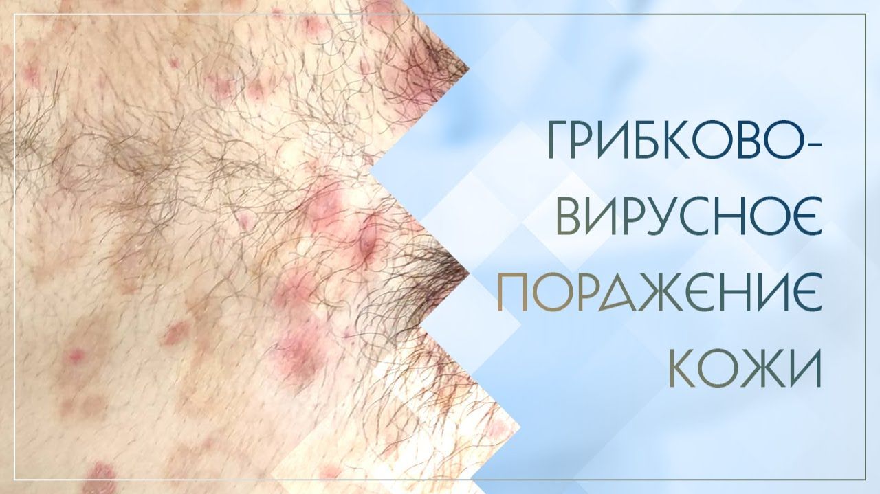 😟 Грибково-вирусное поражение кожи. Клинический случай №60