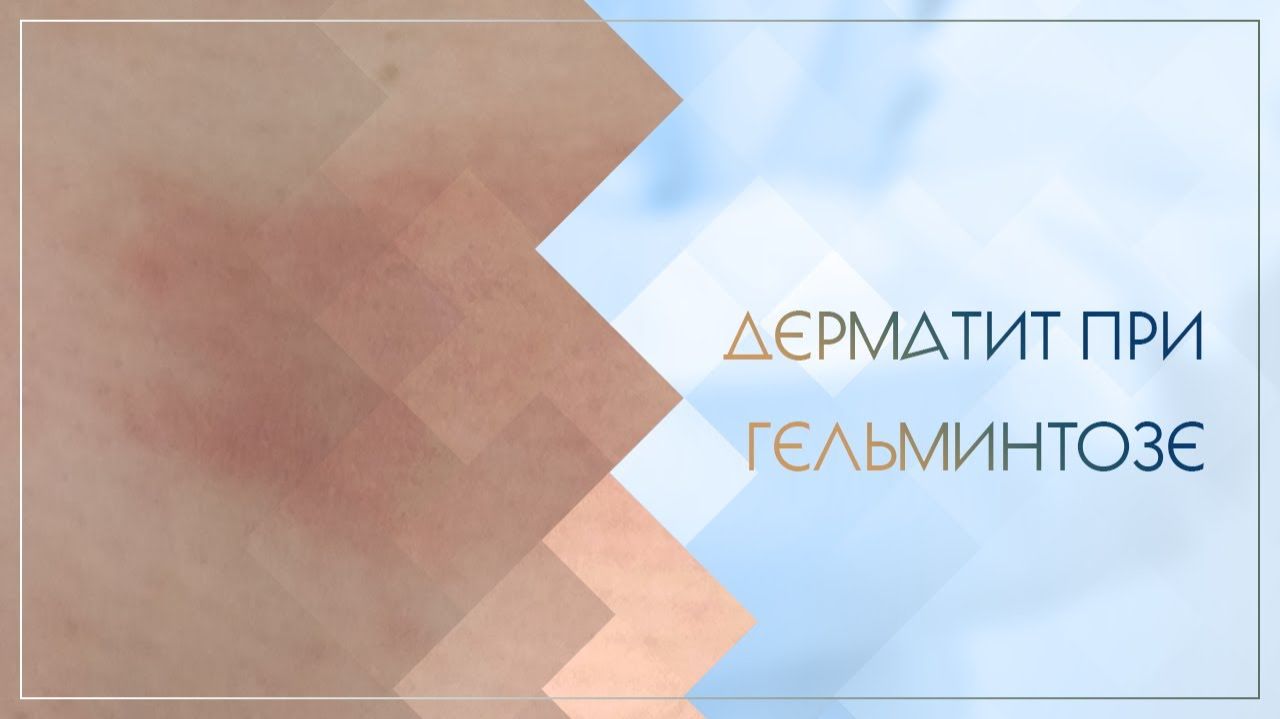 😟 Дерматит при гельминтозе. Клинический случай №47