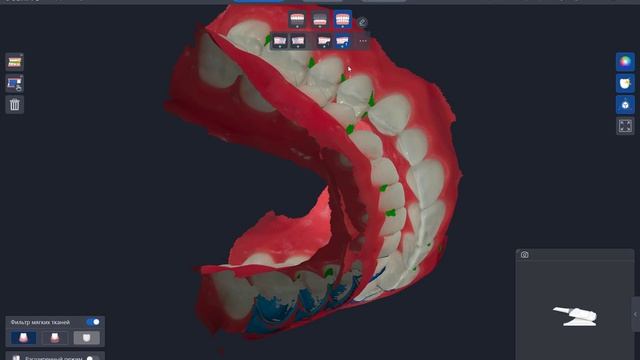 Сканирование прикуса, дополнительного прикуса и движения нижней челюсти