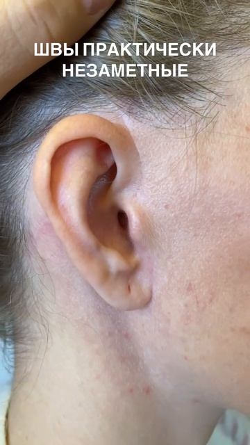 До и после операции омоложения лица у пластического хирурга Типикина Дмитрия Олеговича