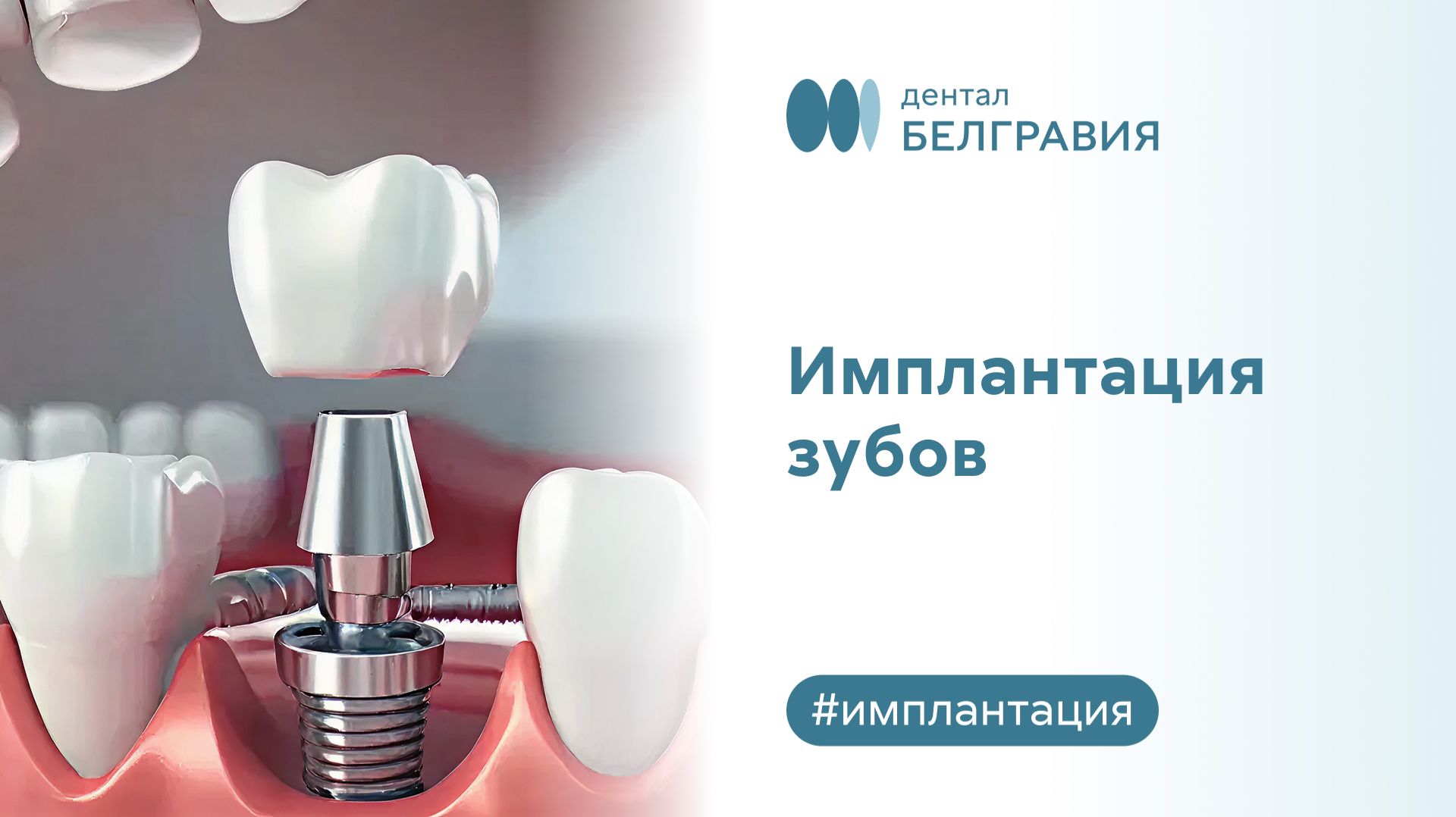 🦷 Имплантация зубов в клинике Дентал Белгравия
