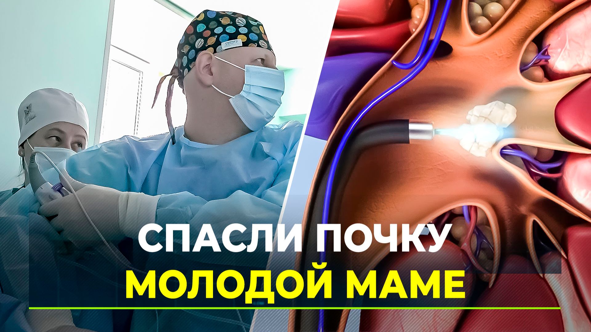 Комбинированную урологическую операцию провели на Ямале