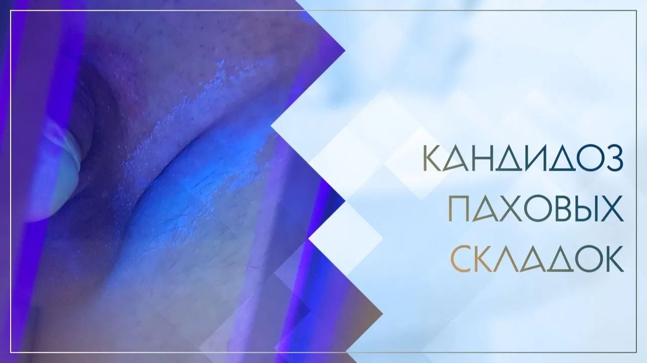 😐 Кандидоз паховых складок. Клинический случай №36