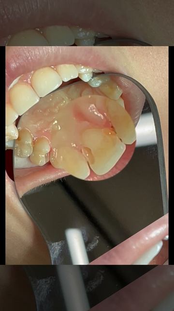 Лечение зубов под микроскопом в Москве