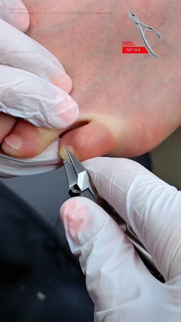 Миф, что онихолизис не прирастает после обработки 😬 продолжение уже в ленте