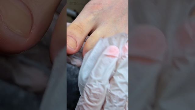 Инструмент, которым сложно поранить клиента В конце можно увидеть динамику отрастания онихолизиса