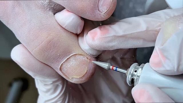 онихолизис НЕ ОТРАСТАЕТ после обработки!  так только кажется, в конце видео есть результат до/после