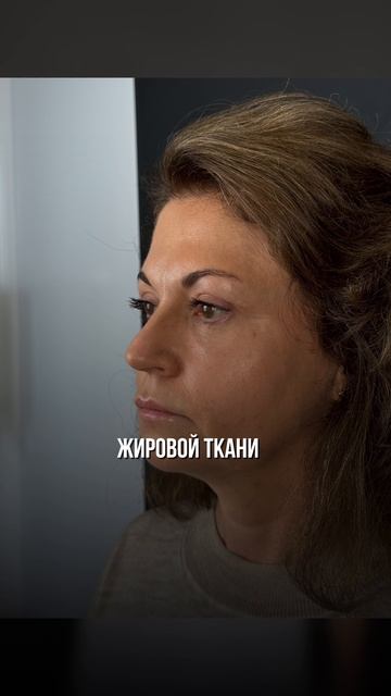 Омоложение области вокруг глаз