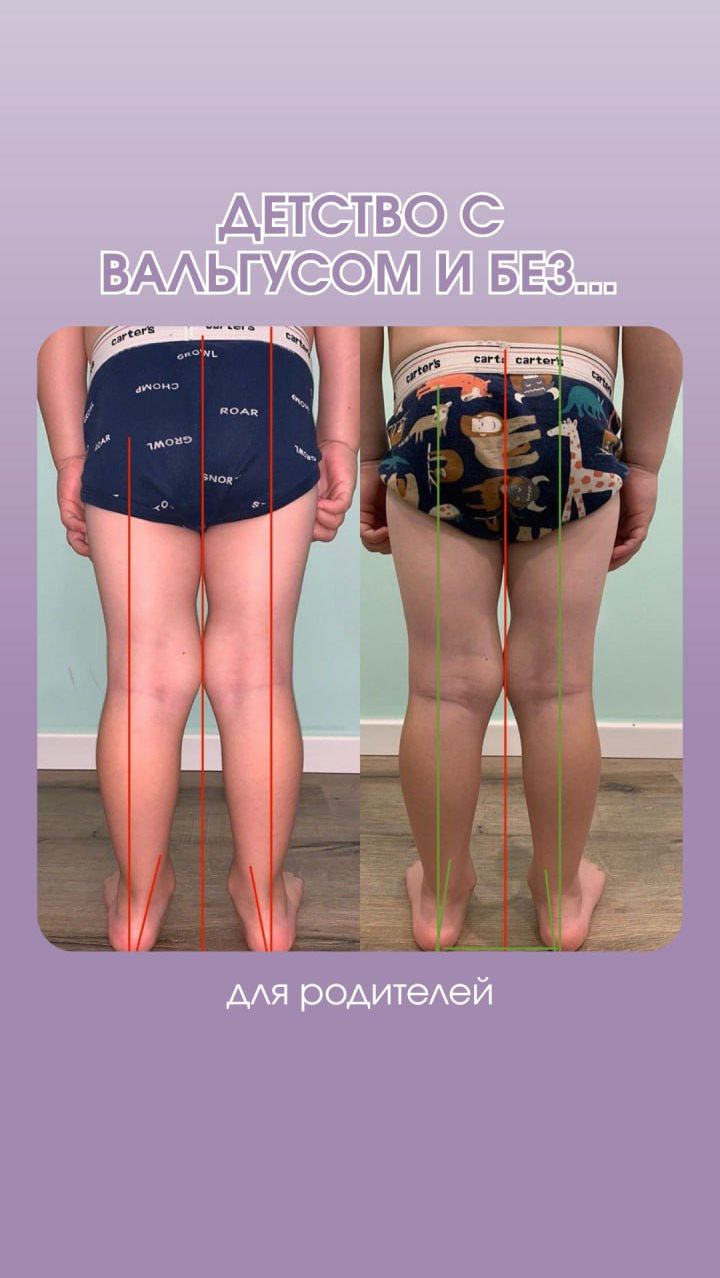 Детство с ВАЛЬГУСОМ и БЕЗ...