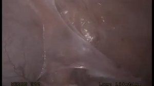 Лапароскопическое низведение яичка после пересечения яичковых сосудов