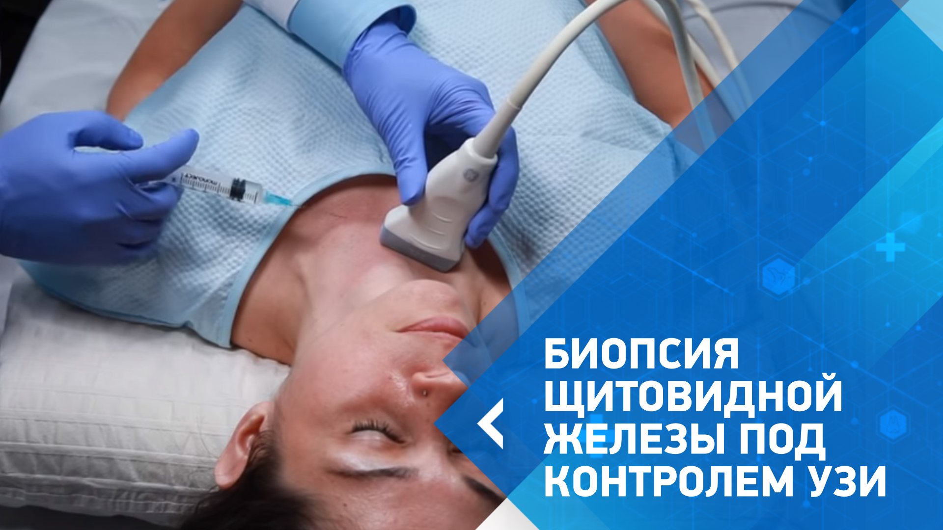 Биопсия щитовидной железы под контролем УЗИ