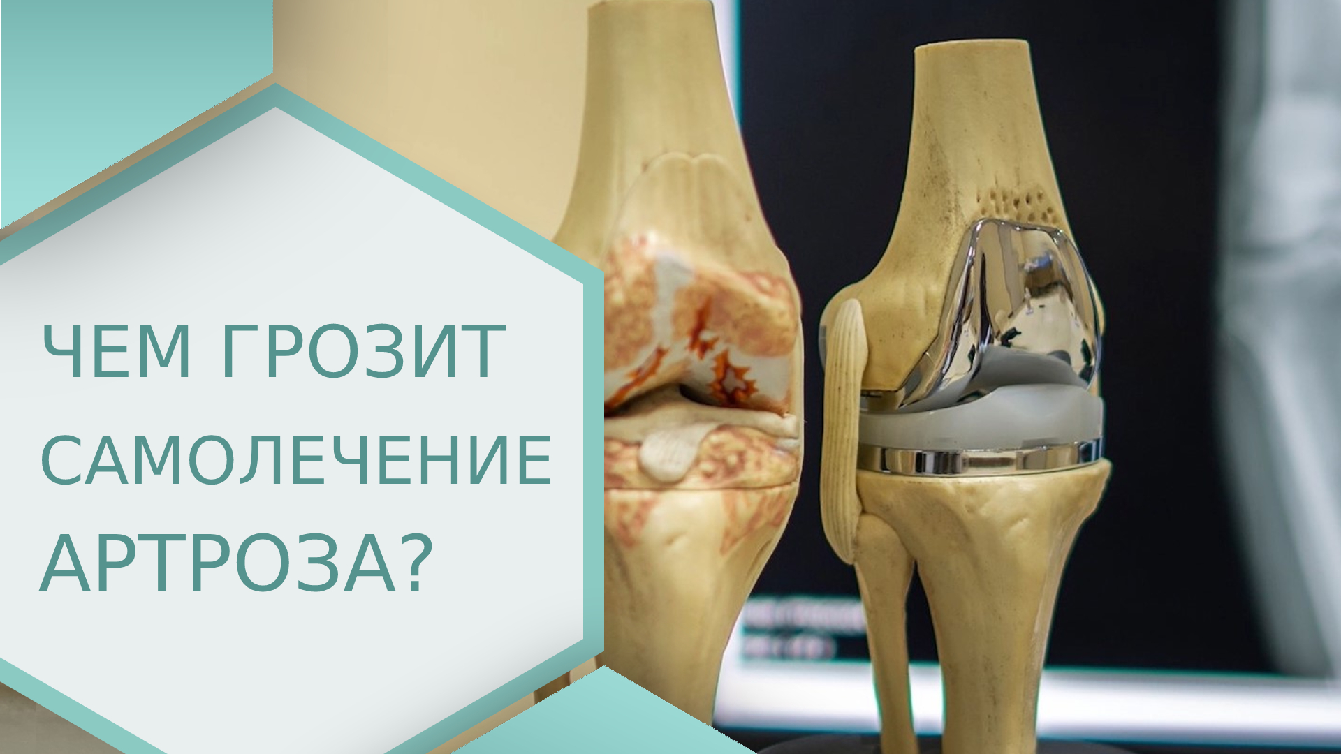 ? Оперативное и медикаментозное лечение артроза коленного сустава. Медикаментозное лечение артроза.