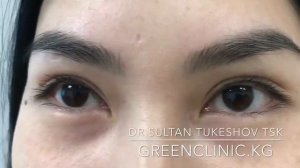 Пластика век авторским методом Доктора Султана Тукешова. Green Clinic Bishkek, тел:+996770899242