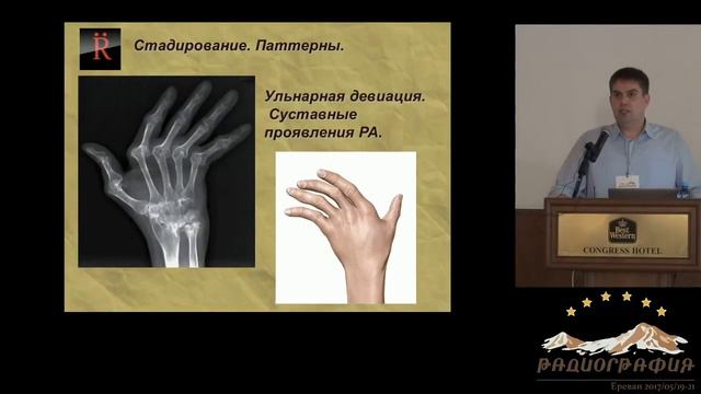 Лучевая диагностика ревматоидного артрита