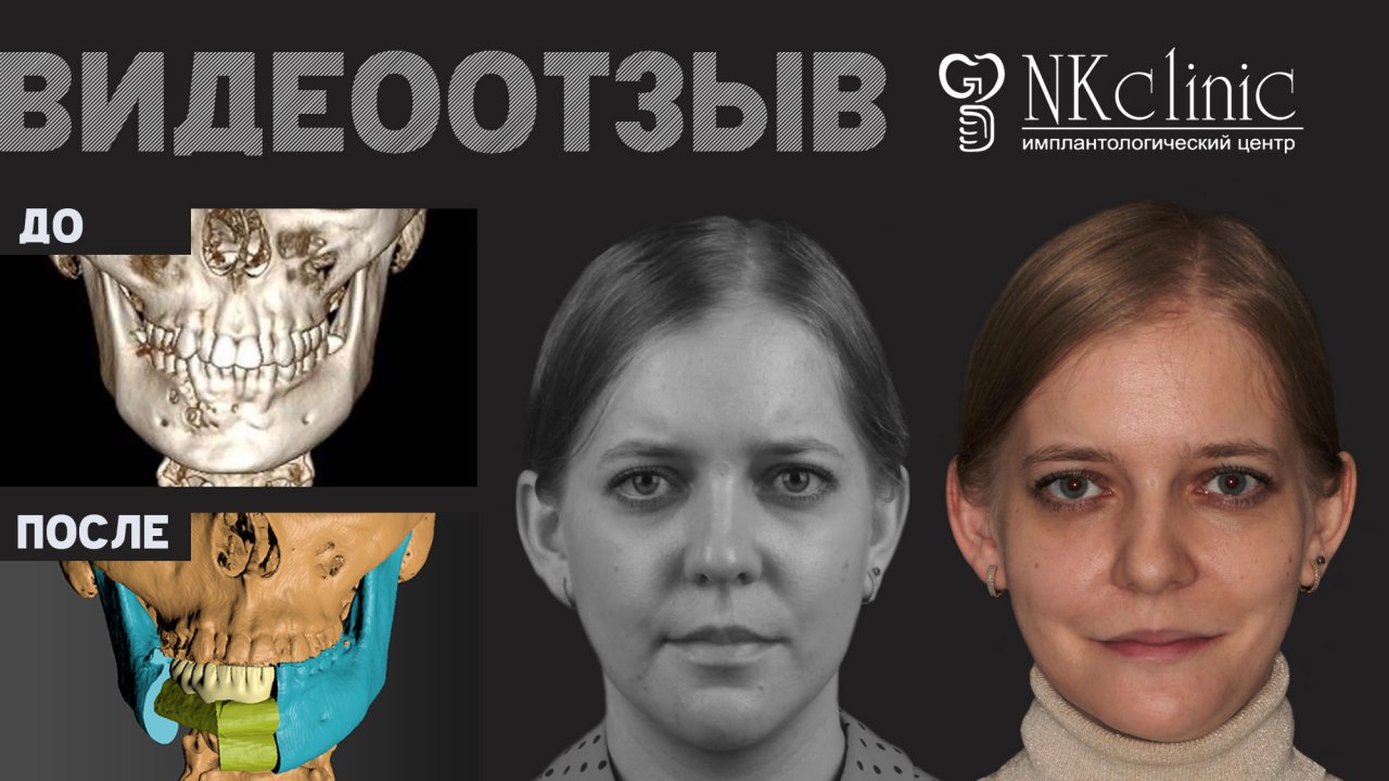 Удаление опухоли (амелобластомы) нижней челюсти. Видеоотзыв пациентки