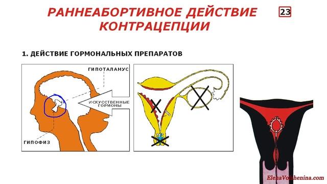 Восстановление плодности после удаления спирали (ВМС) - Урок4.