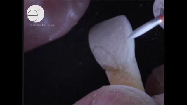 Реставрация переднего зуба из композита - Li Liujingjin
