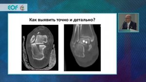 Переломовывихи пяточной кости - волк в овечьей шкуре