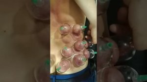 Ударно динамический МАССАЖ с применением вакумной терапии