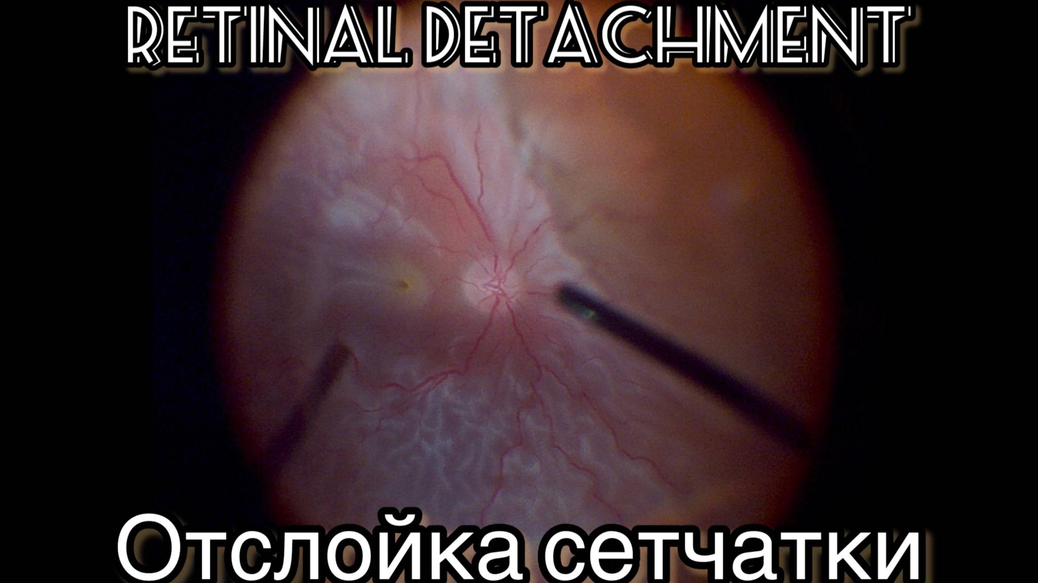 Операция: отслойка сетчатки (Operation: retinal detachment)